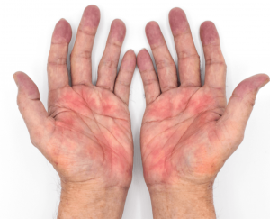 Syndrome main pied : causes, symptômes, traitements