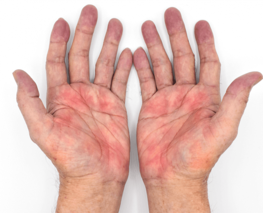 Syndrome main pied : causes, symptômes, traitements